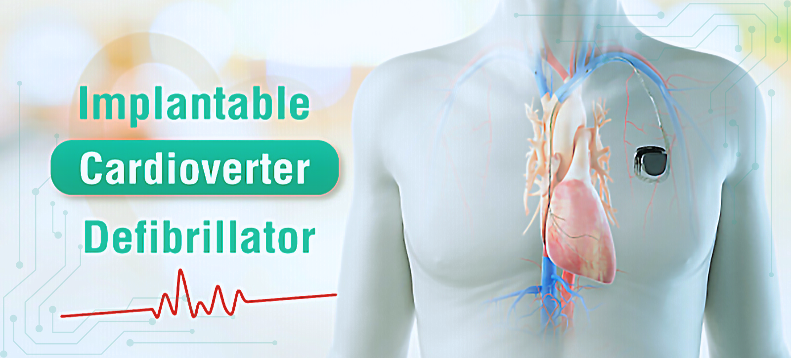 Implantable Cardioverter Defibrillator (ICD)