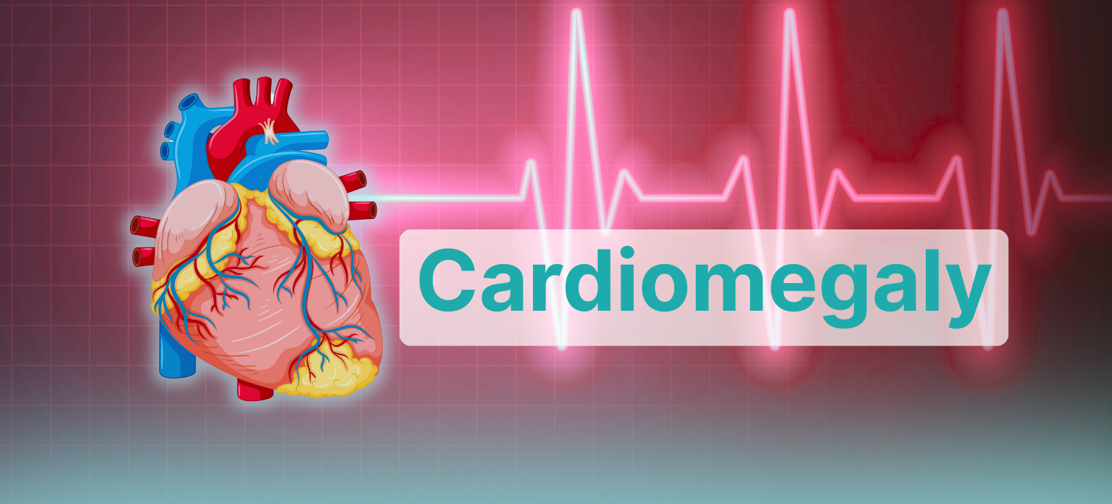 Cardiomegaly: An Important Indicator of Cardiac Stress